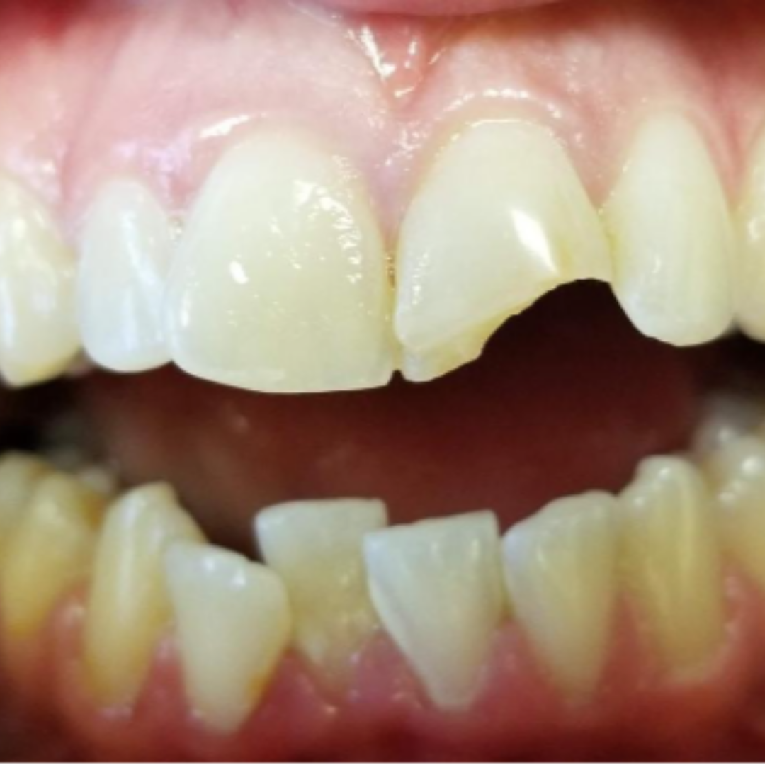 Qué hacer si se te ha partido un diente - MyDentiss